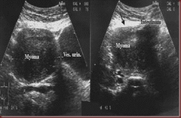 eirichzon3: Mioma Uteri
